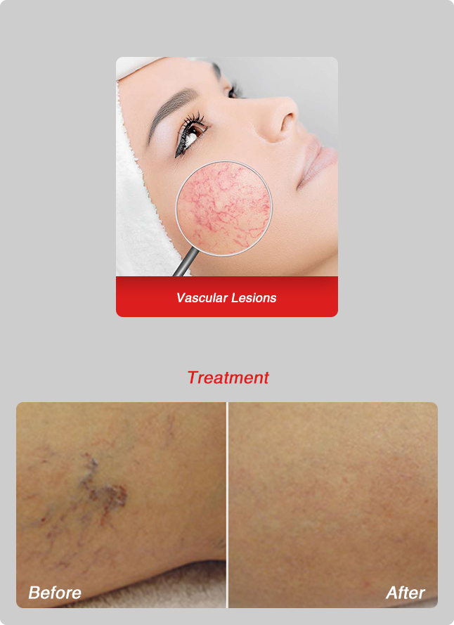 sp-st-qx-Vascular Lesions – richmondmedical
